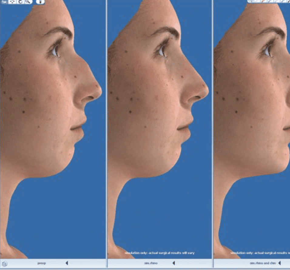 Rinoplastia: una cirugía con sentido artístico - Instituto Dr. Vicente ...